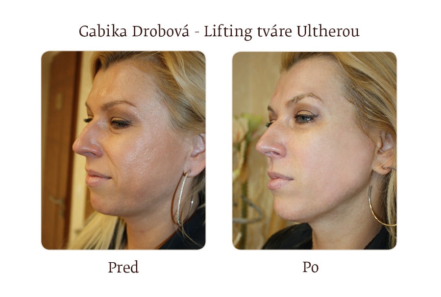 Čobejová a Drobová absolvovali lifting tváre! – galéria | Topky.sk